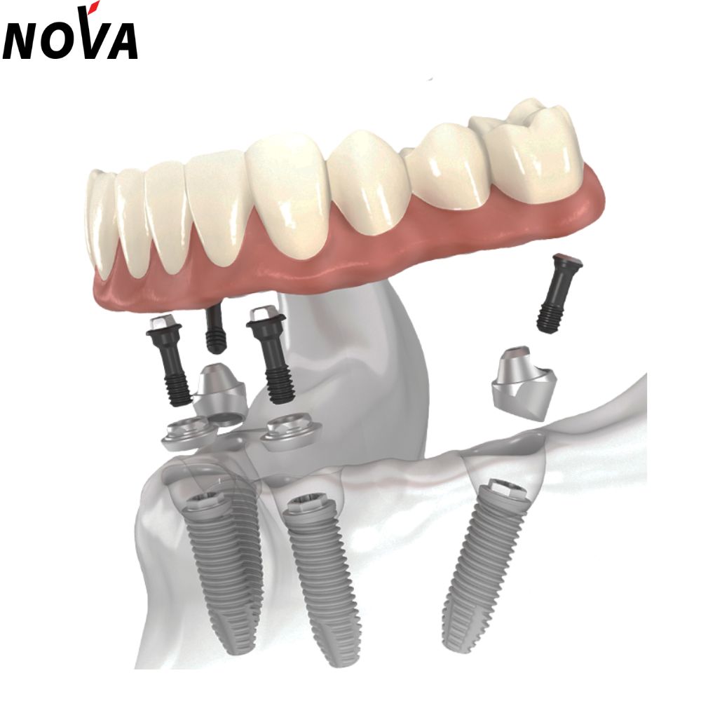 Nova Implant USA Distributor – buynovaimplantsusa